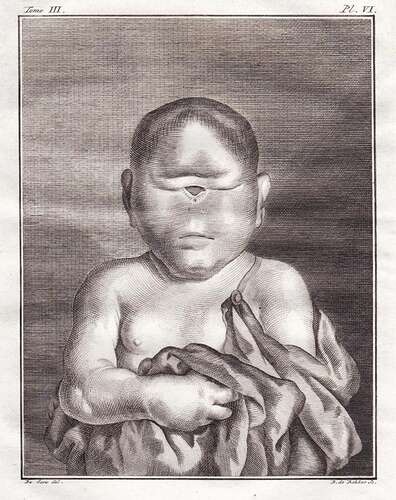 Pl. VI - Zyklopie cyclopia medical abnormality Medizin Physical ...