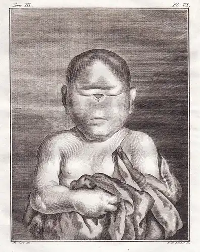Pl. VI - Zyklopie cyclopia medical abnormality Medizin Physical ...