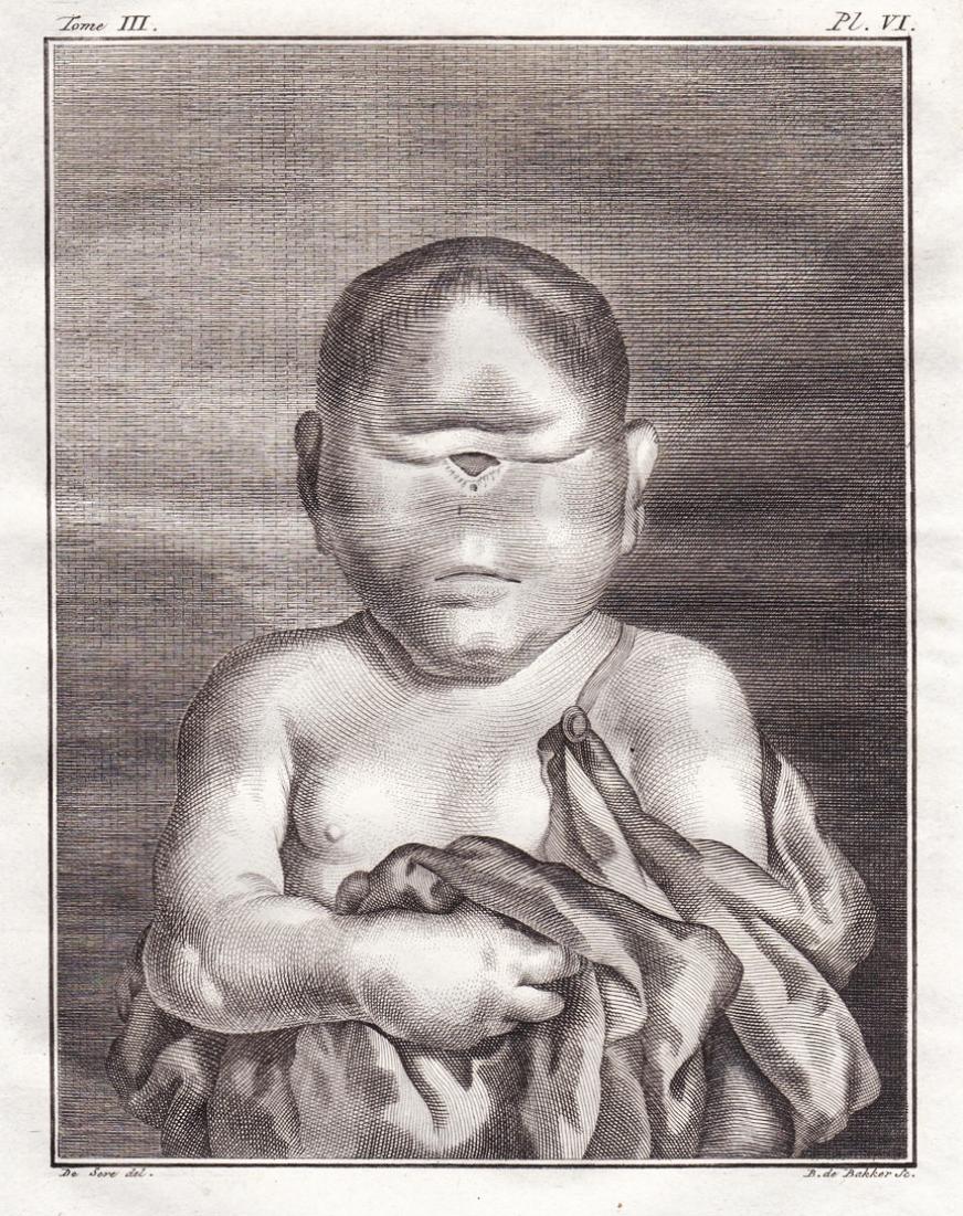 Pl. VI - Zyklopie cyclopia medical abnormality Medizin Physical ...